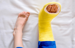 Buckle fracture in children: Causes, Symptoms and Treatments – From Doctor